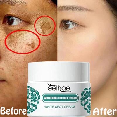 Niacinamide Melasma Brightening Cream Reduce Melanin Lighten