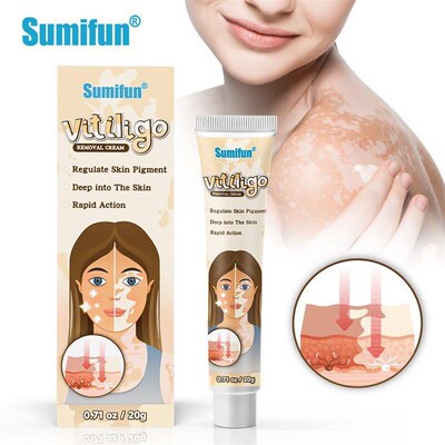 Eliminate Skin Vitiligo Cream Remove Ringworm White Spot