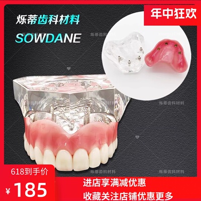 牙科种植修复上颌义齿分解