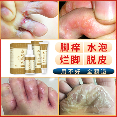 脚气止痒脱皮杀菌喷雾烂脚丫糜烂脚趾缝水泡专用真菌感染特效克星