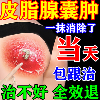 皮脂腺囊肿膏专药用去除皮下粉瘤火疖子拔毒拔脓包硬块特效敷料贴