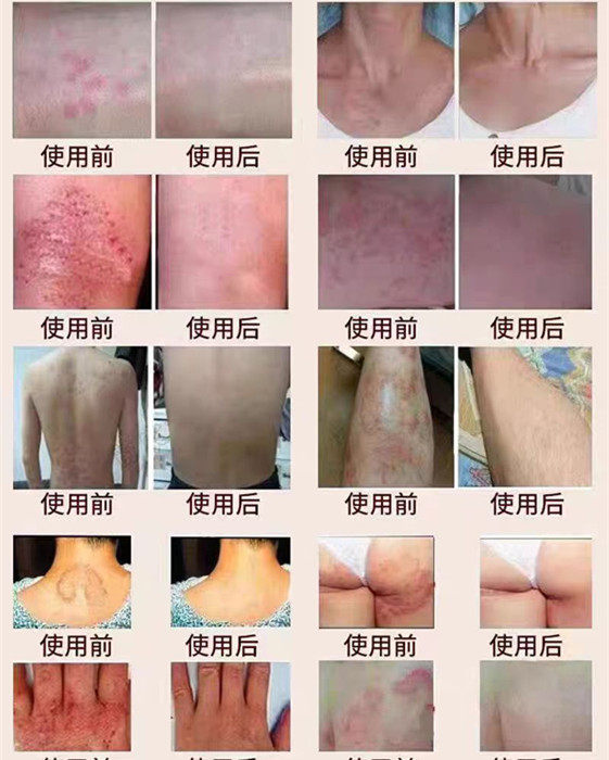 江西源头工厂承接各种规格皮肤乳膏代工贴牌乳膏草本植物奇痒
