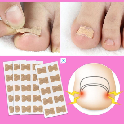 10/20PCS Ingrown Toenail Correction Stickers Glue Free Ing