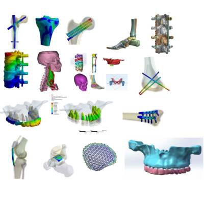 人体mimics建模测量 医学有限元 骨骼有限元代做 ANSYS ABAQUS