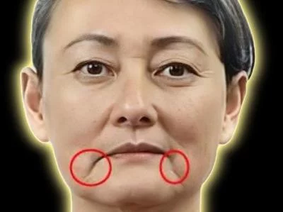 嘴角向下修复精华 提升改善下垂嘴角上扬精油天然免洗