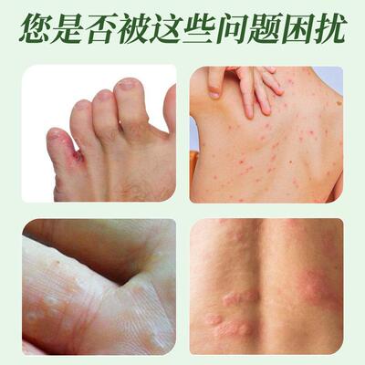 蜕癣消痒膏灵草本足乳膏官方正品止皮EGY肤手脱皮全身抑瘙湿痒菌