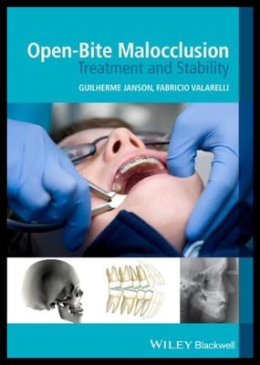【预售】Open-Bite Malocclusion: Treatment and