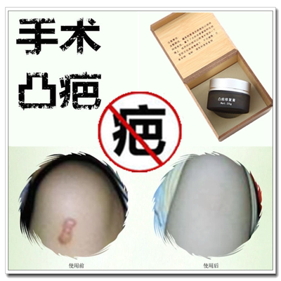 去痣疤不得留除摔伤疤痕贴修复疤停药却疤膏消祛手术伤口愈合凝胶