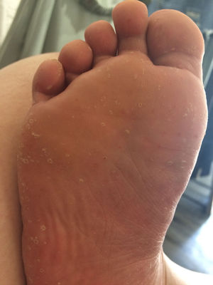 脚底脱皮掉皮起水泡痒脚后跟起干皮蜕皮长水泡钻心痒脚底起皮烂