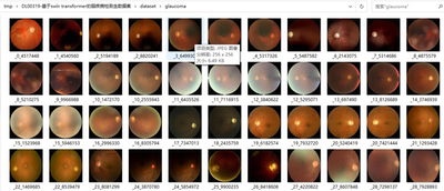 DL00319-基于swin transformer的眼疾病检测含数据集完整