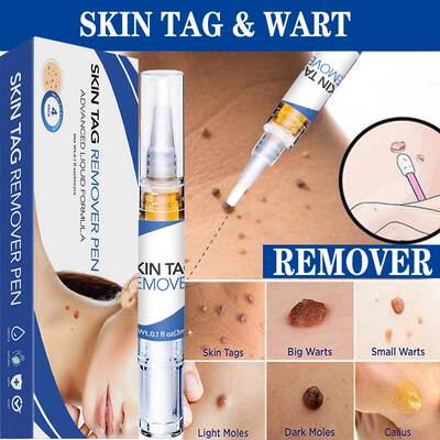 Skin Tag Remover Agat Moles 12 Hours Fast Removal Genital Wa