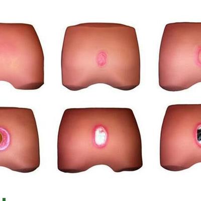 高级压疮病情演l示模型压疮护理模型褥疮护理模型