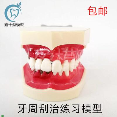 牙科牙结石刮g治练习龈下去除模型牙周病理模型医患教学教具4025