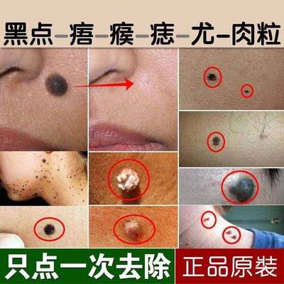 正品消志去肉痣无痕脱痣膏消痣药水修复素点雀除志灵去痦子黑痣
