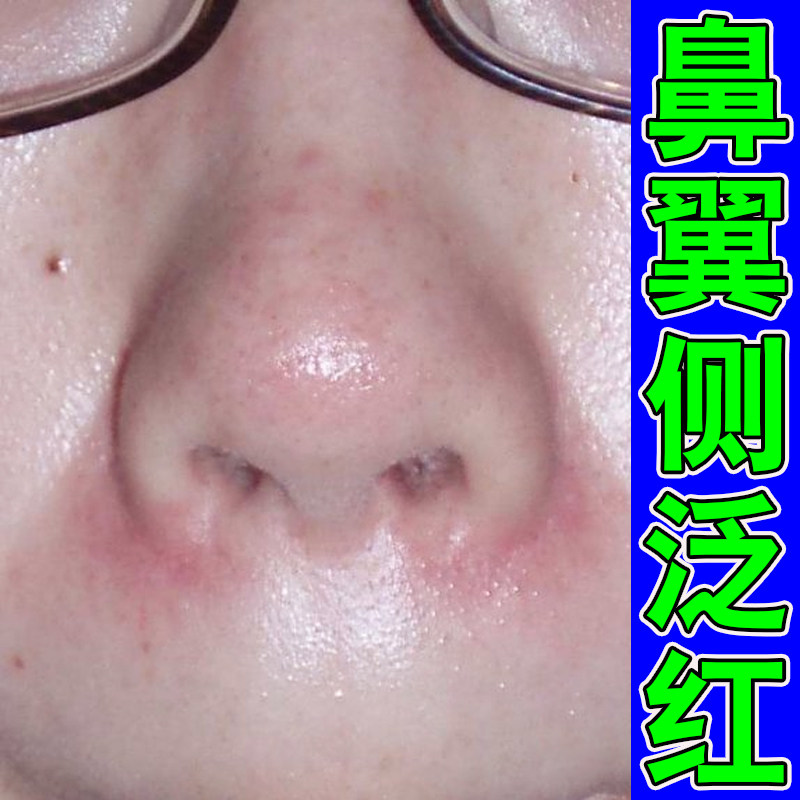 鼻翼脂溢性泛红面部软膏鼻子两侧发红脸上皮肤起皮红血丝敏感