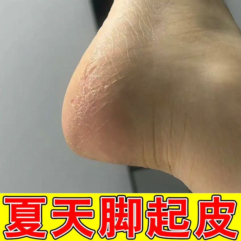 手足干裂膏脚后跟干裂修护足霜手蜕皮脚裂滋润保湿修护裂口