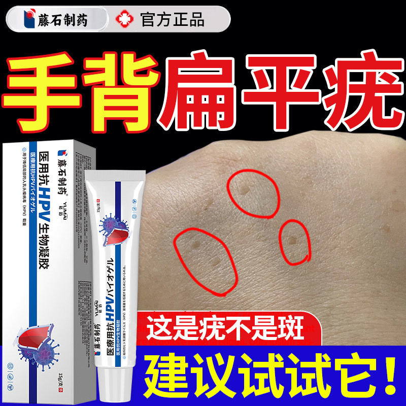 手背扁平疣专用搭膏药贴去除膏一去疣抹灵丝状神器干扰素b2凝胶KD