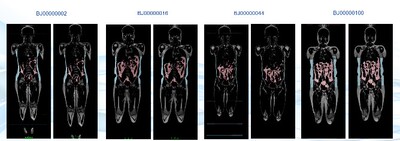 DL00644-深度学习医学影像对腹部皮下脂肪内脏脂肪和大腿肌肉分割
