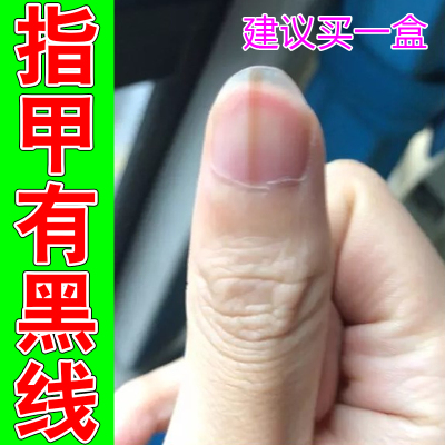 指甲有竖纹黑线凹凸不均增厚发黄空甲分层干枯脆弱甲床滋养修护药