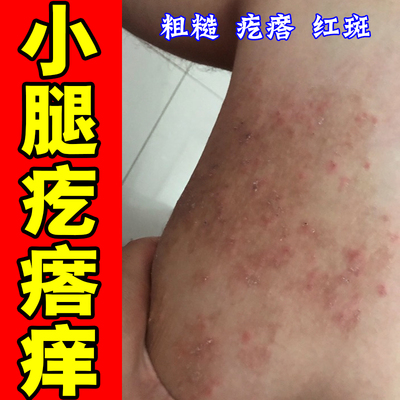 小腿大腿内侧干痒疙瘩痒起红斑长红点粗糙一挠就痒干燥红疙瘩专用