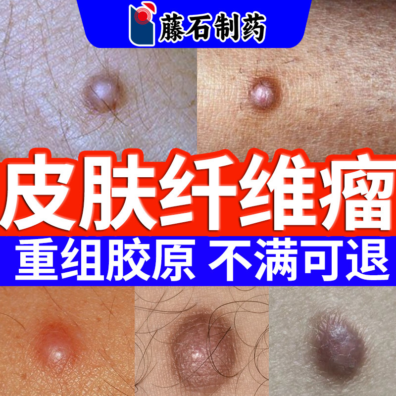 皮肤纤维瘤膏脂肪瘤膏肿硬块除可搭膏药贴皮下粉瘤疙瘩去SE