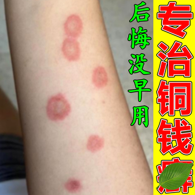 铜钱鲜体鲜专用皮肤干燥鳞屑外用膏