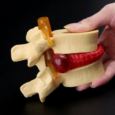 Anatomical Spine Lumbar Disc Herniation Anatomy Teaching Too