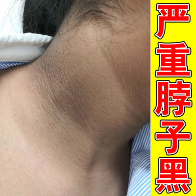严重脖子黑夏天皮肤晒黑去脖子黑色素沉淀除脖颈洗不干净黑棘皮