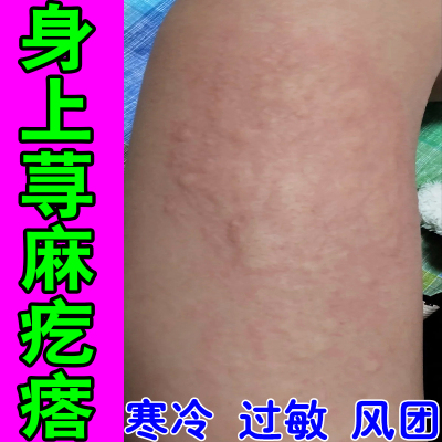 冶身上荨麻疙瘩皮肤过敏痒换季风团顽固慢皮肤痒起红疙瘩药乳