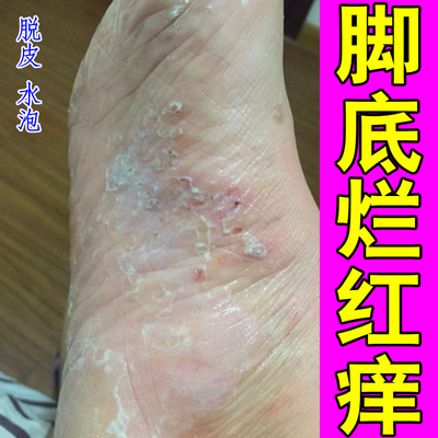 脚底红痒刺挠痒抓挠出血皮肤干燥粗糙脚臭又痒脱皮水疱疙瘩水泡