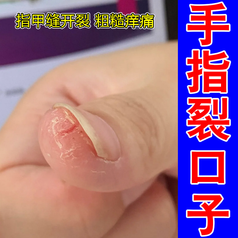 手裂口专用手指蜕皮足部脱皮掉屑手指关节红肿痒真菌草本修复药乳