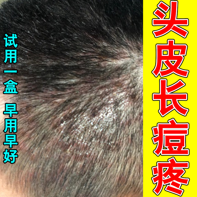 头上长痘毛囊专用头皮起红疙瘩脓包脂溢性皮真菌染专用膏