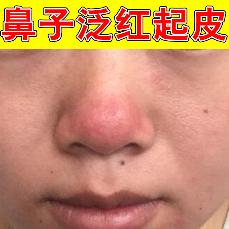 鼻子两侧泛红脱皮鼻子周围干燥起皮发红干痒修复脂溢性软膏