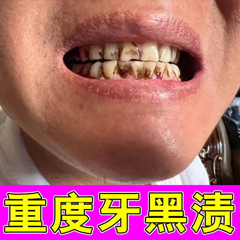 牙斑净牙齿速掉黄牙液洗污垢烟茶渍牙菌斑清洁分离神器植物牙液