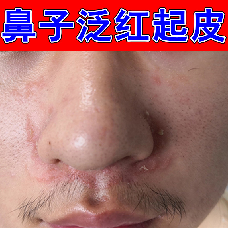 冶鼻子两侧发红脱皮脸上鼻翼两边泛红痒干燥起皮专用草本修护乳膏