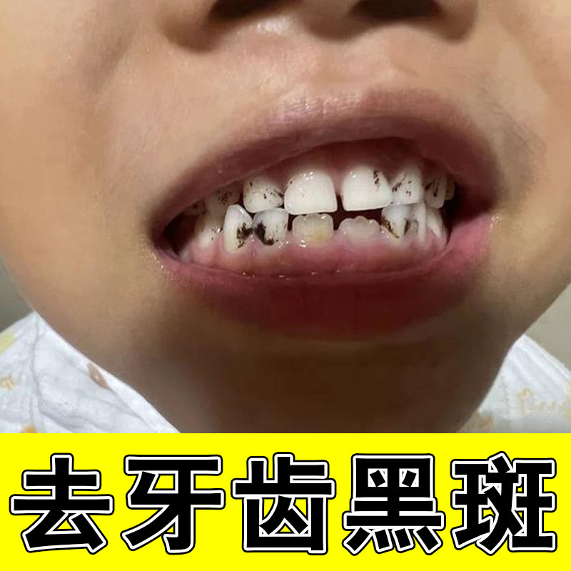 牙斑净好用清洁牙齿黄黑斑烟渍茶渍牙菌斑牙垢洁牙粉白牙素洗牙液