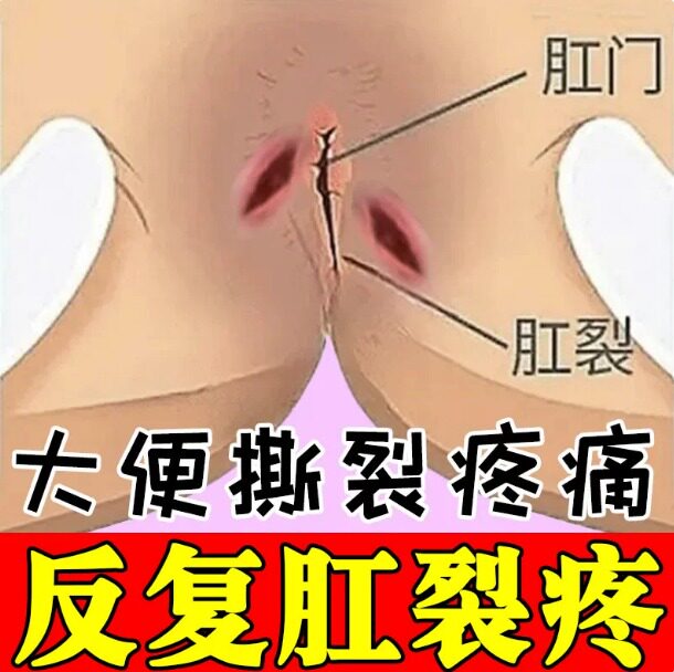 肛裂愈合膏肛瘘大便出血肛破肛周脓肿痒外用非