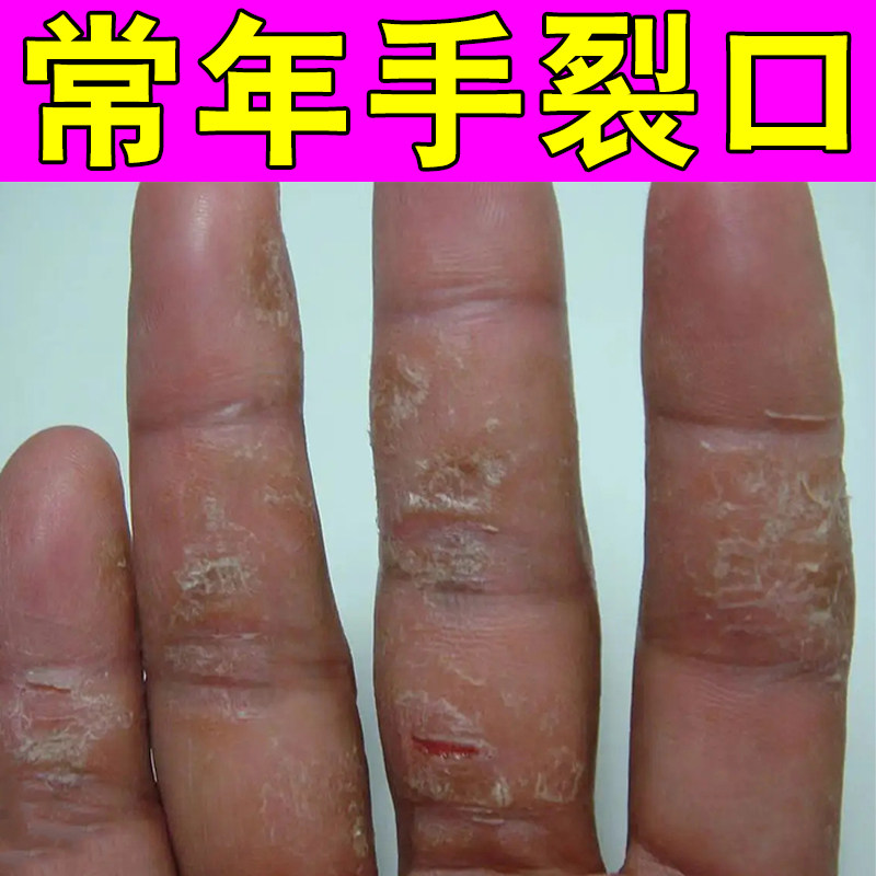 手干燥粗糙手裂口子手背刮风干裂刺痛修复保湿护手足手皴裂愈合膏