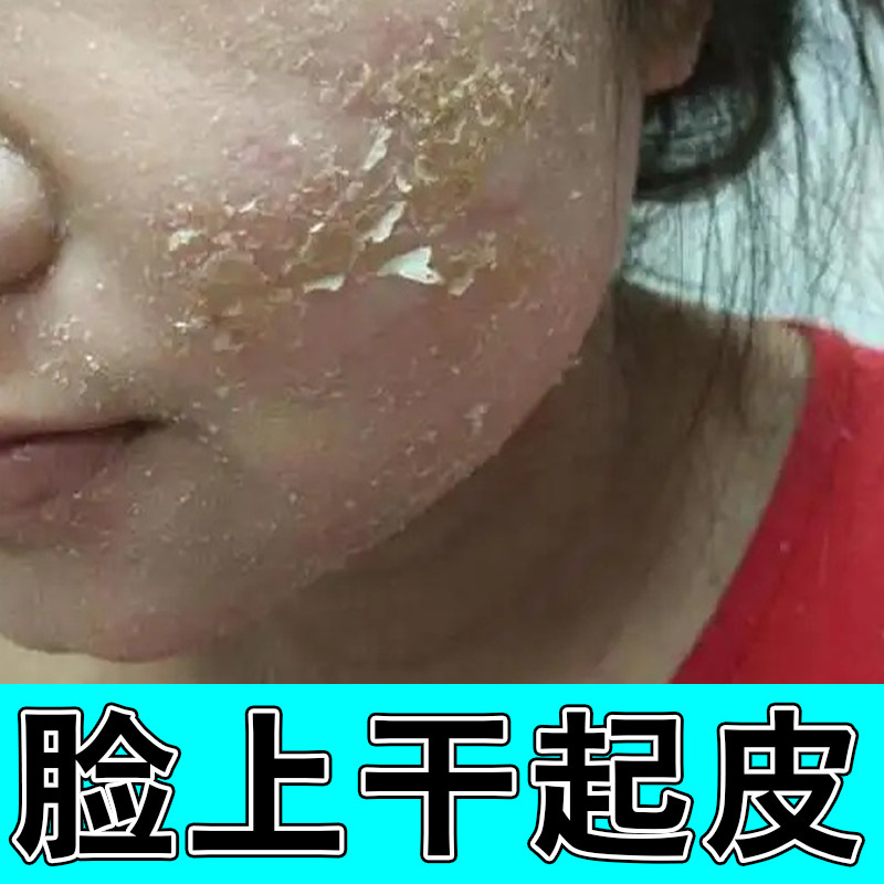 脸干燥起皮嘴角有碎屑脱皮紧绷脸上皮肤长干皮痒泛红修复甘油