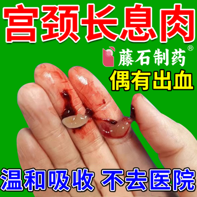 子宫内膜息肉中药贴宫颈息肉消化散调理内膜炎增厚月经淋漓不尽XP