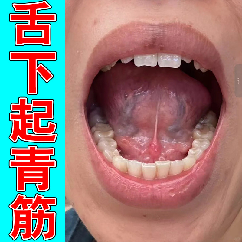 舌下长肉芽疙瘩有硬块青筋堵塞肿唾液有异物感疼草本修护喷剂
