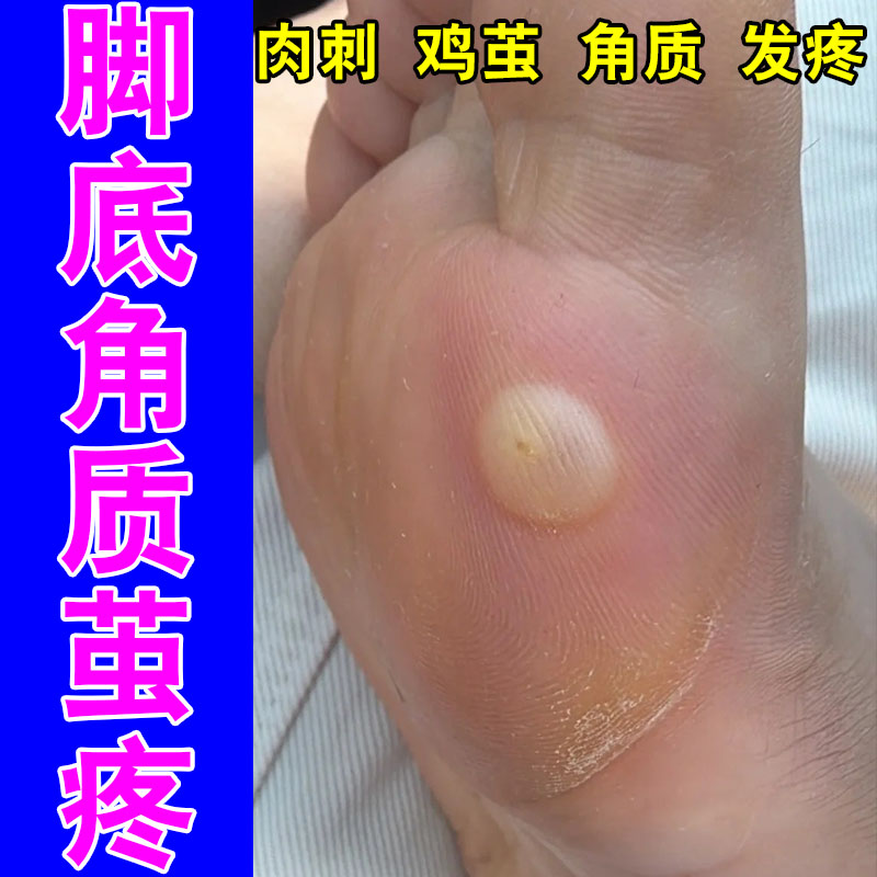 脚底脚垫厚茧硬茧脚趾关节角质脚钉足部肌肤修护脚贴