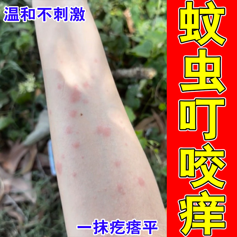 蚊虫叮咬痒肿挠身上起红疙瘩小腿痒皮肤发红过敏草本喷剂