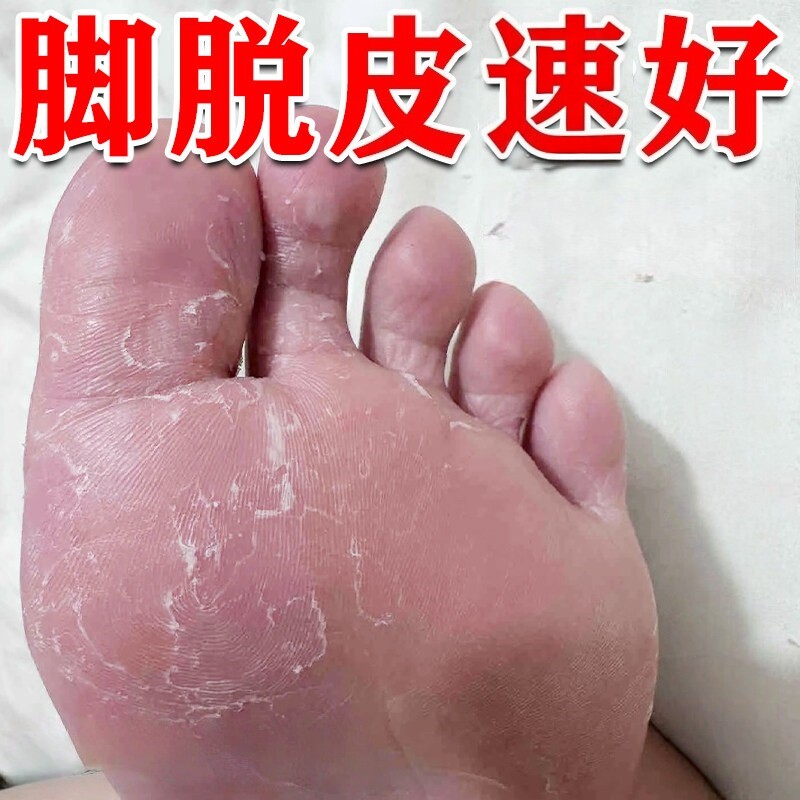 脚底脱皮专用膏干裂手掌脚心皮肤干燥开裂起皮脱皮脚掉皮用什么药