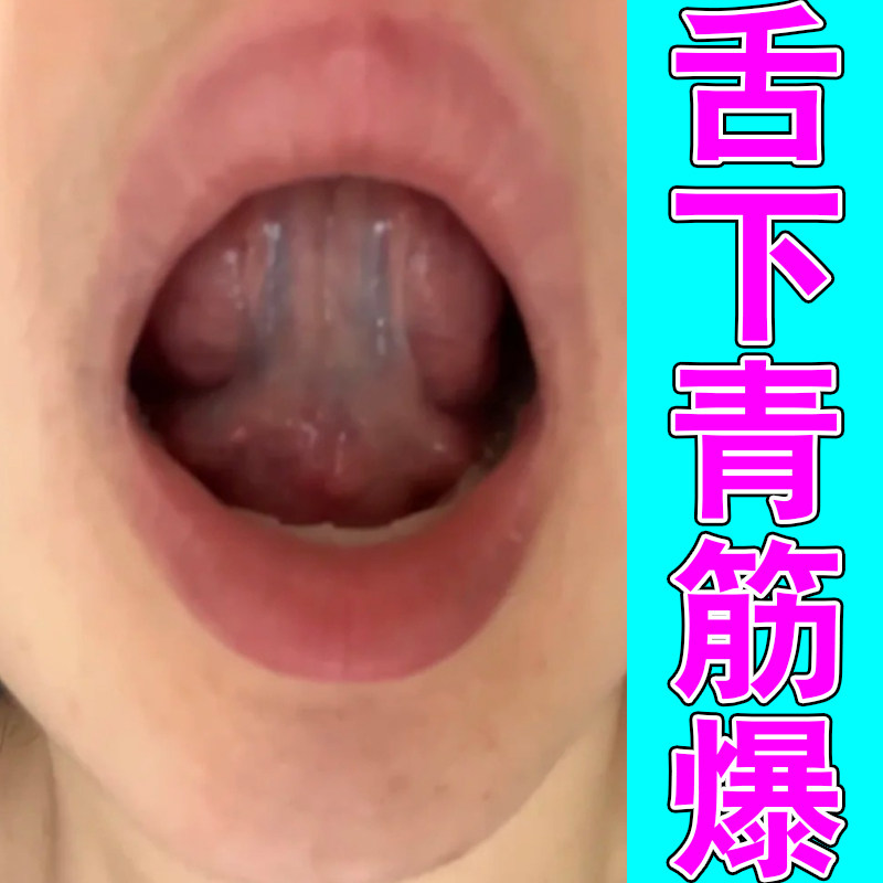 草本疏通舌下粗黑青筋舒缓舌根肿痛舌底血管淤堵塞草本喷剂