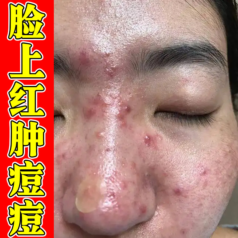 脸上红肿痘痘脓包疙瘩鼻子上起硬块痘内分泌失调脸颊长痘专用乳膏