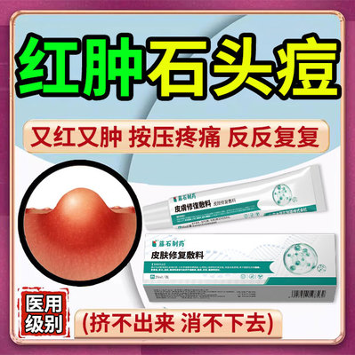 红肿石头痘硬块痘脓包痤疮结节囊肿姨妈上火痘药红肿监备案膏AH