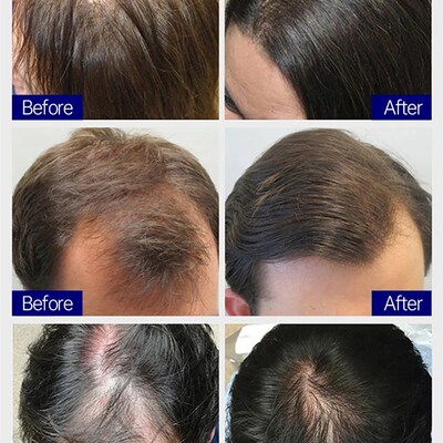 好货Fast Hair Growth Hair Follicle Treatment Hair Growth Seb