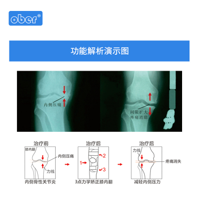 ober可调节膝关节护膝 骨性关节 矫正膝内外翻支具O/X型腿矫形器
