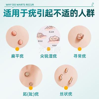 瘊疣膏【财天双猫正品】鸡堂眼膏肉刺瘊BXX子疣皮肤外用抑菌膏